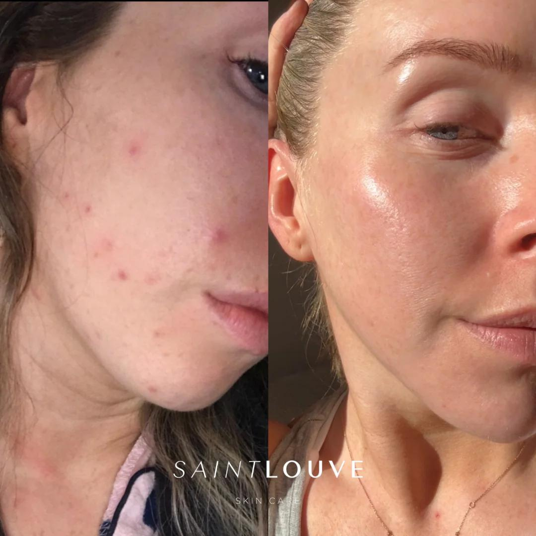 2 Ways to Achieve Glass Skin Without a Single In-Clinic Treatment ...